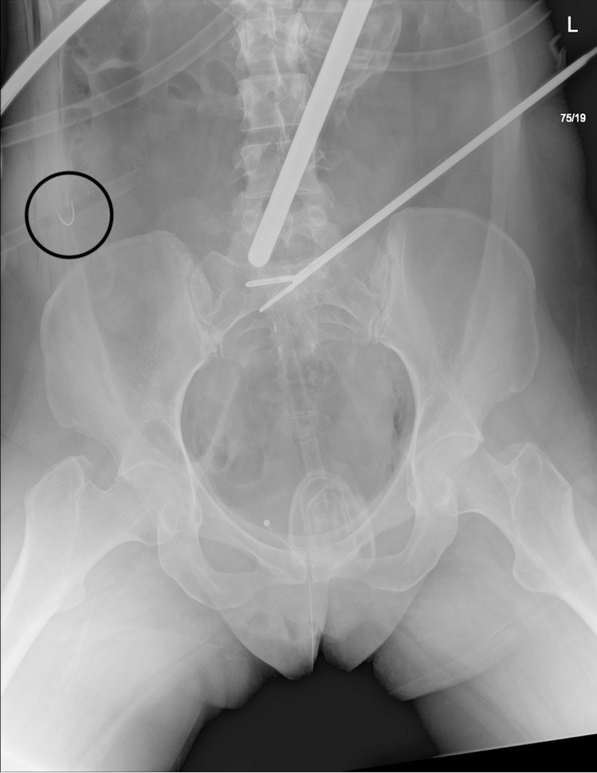Tiny Needles, Big Consequences: Why Detecting Retained Surgical Needles ...